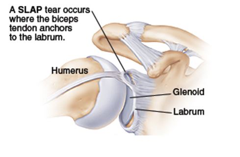 SLAP Tear Treatment Bangalore | Shoulder Joint Injury India