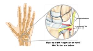 TFCC tear treatment in Bangalore at Shoulder Center,