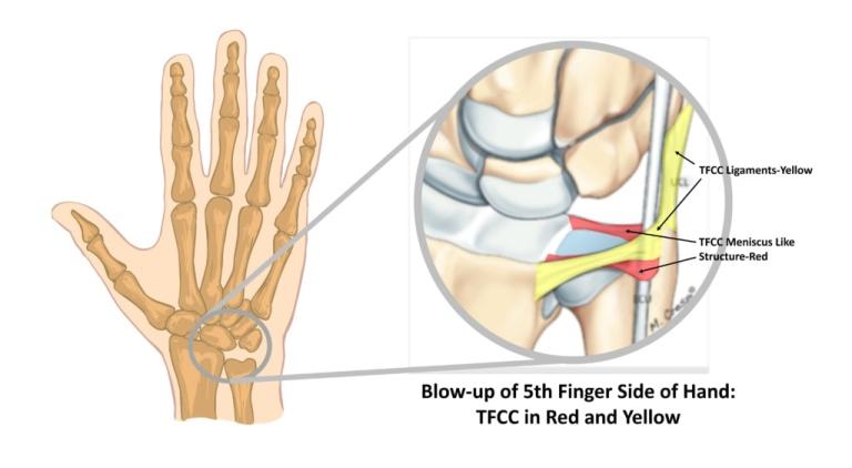 TFCC tear treatment in Bangalore at Shoulder Center,